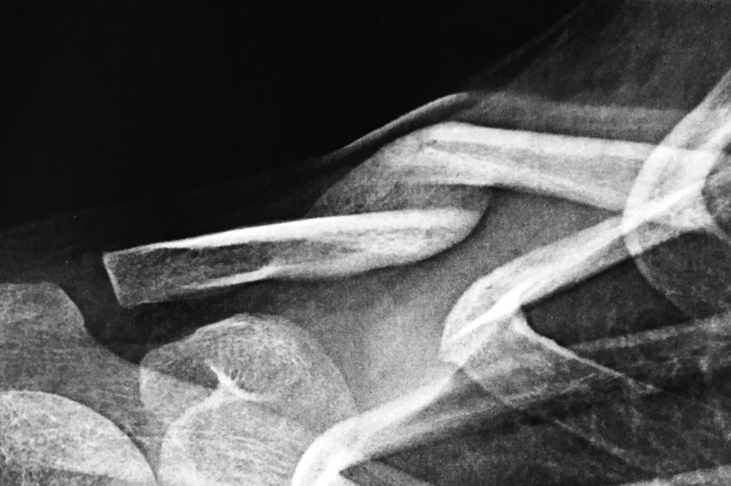 apres formation du cal osseux - INSTITUT DE L’ÉPAULE DE STRASBOURG