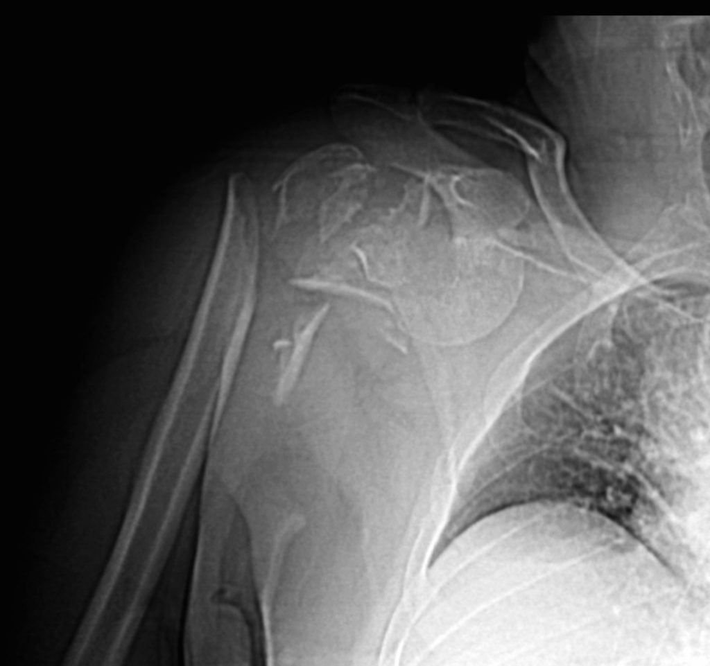 fracture sans contact intervention - INSTITUT DE L’ÉPAULE DE STRASBOURG